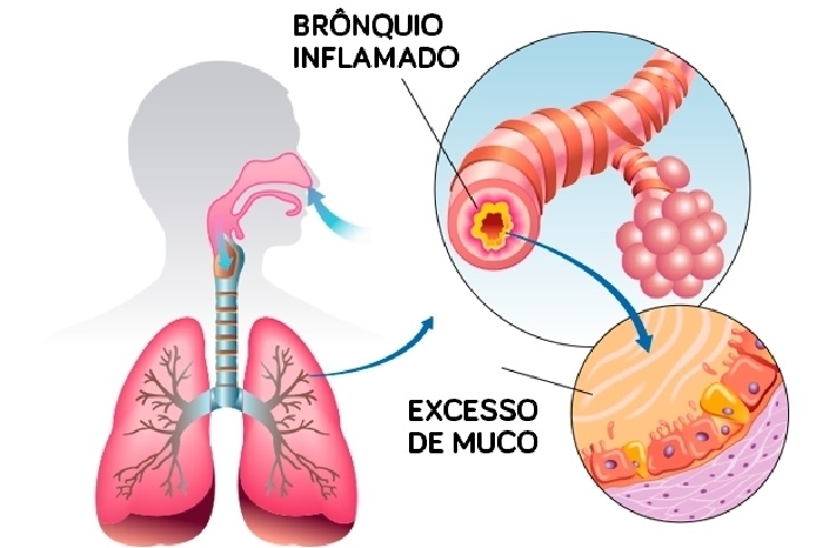 Bronquiolite: O que é, sintomas, causas e tratamento? - Viva Fisio